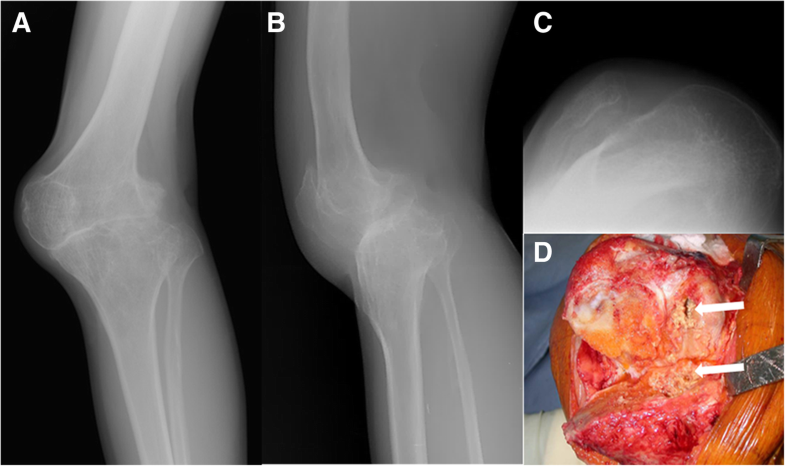 Antibiotic-impregnated articulating cement spacer maintained for 7 ...