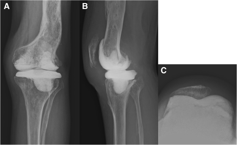 Antibiotic-impregnated articulating cement spacer maintained for 7 ...