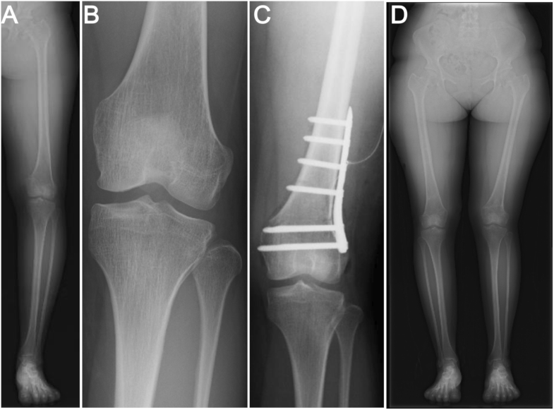 Correction osteotomy for bilateral varus knee deformity caused by ...