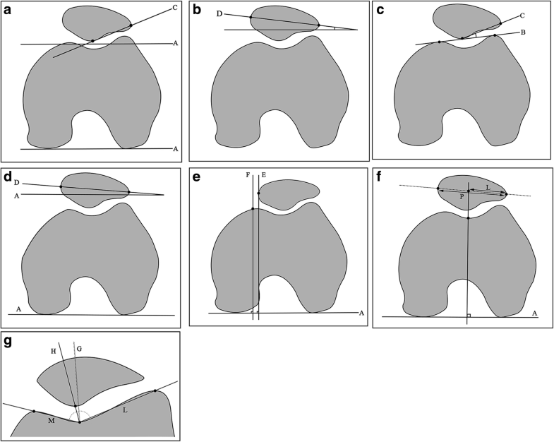 Patellar instability: the reliability of magnetic resonance imaging ...