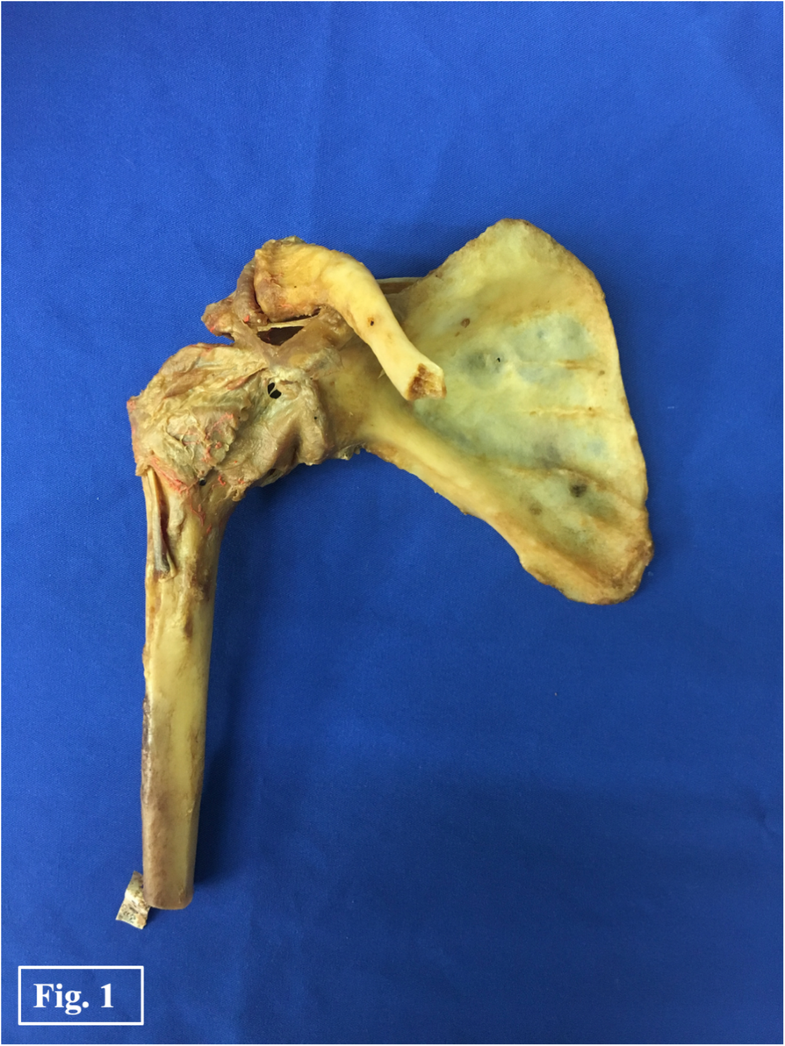 Novel implant-free loop Tenodesis vs. simple Tenotomy of the long ...