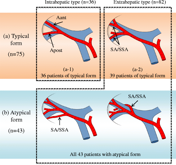 Surgical anatomy of the right hepatic artery in Rouviere’s sulcus ...