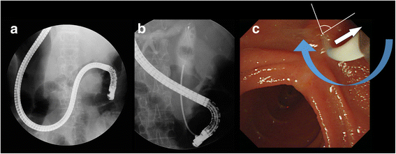 Successful access to the ampulla for endoscopic retrograde cholangiopancreatography in patients ...