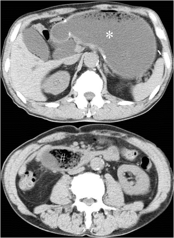 Obstruction in the third portion of the duodenum due to a ...