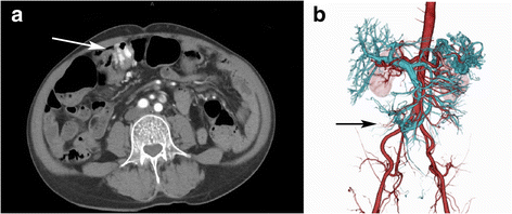 Arteriovenous malformation in the sigmoid colon of a patient with ...