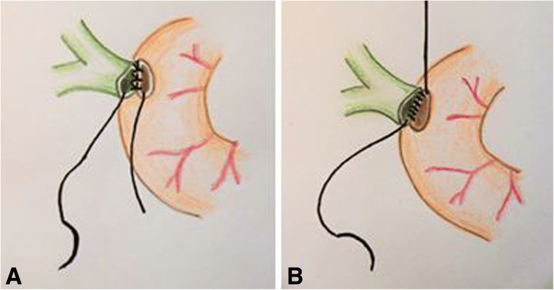 Continuous or interrupted suture technique for hepaticojejunostomy? A ...