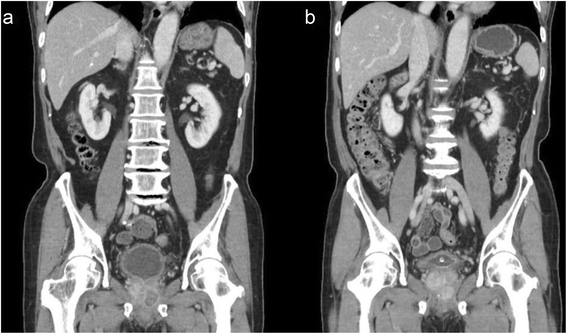 Acute bacterial prostatitis and abscess formation | BMC Urology | Full Text