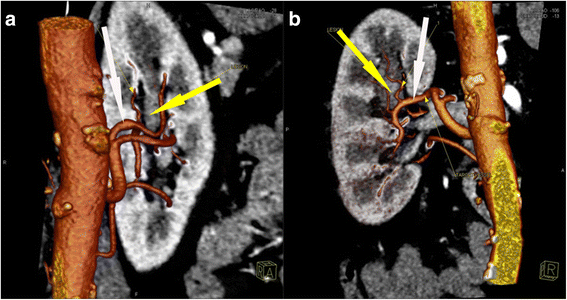 Retroperitoneal laparoscopic partial nephrectomy with segmental renal ...