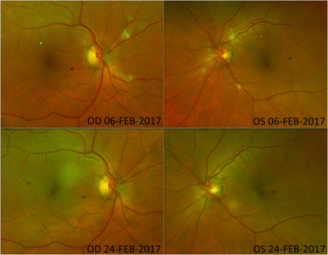 Fungaemia caused by obstructive renal candida bezoars leads to ...