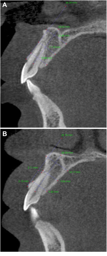 Anterior maxilla alveolar ridge dimension and morphology measurement by ...