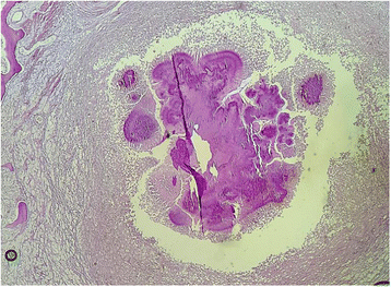 Mycetoma in a non-endemic area: a diagnostic challenge | BMC Clinical ...