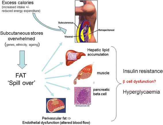 Type 2 diabetes as a disease of ectopic fat? | BMC Medicine | Full Text