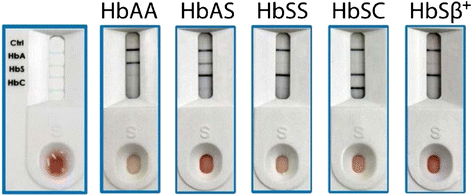 Validation of a novel point of care testing device for sickle cell ...