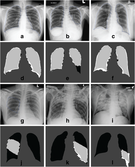 Lung segmentation on standard and mobile chest radiographs using ...