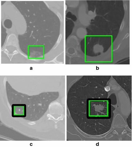 Computer-aided detection (CADe) and diagnosis (CADx) system for lung ...