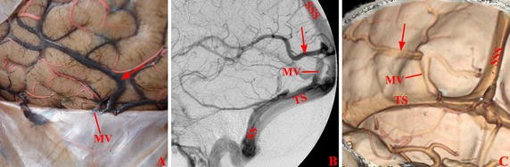 Anatomic comparison of veins of Labbé between autopsy, digital ...