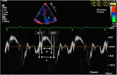 Myocardial performance index in female athletes | Cardiovascular ...