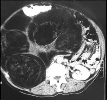 Well-differentiated abdominal liposarcoma: experience of a tertiary ...
