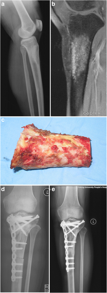 Reconstruction of segmental bone defect of long bones after tumor resection by devitalized tumor ...