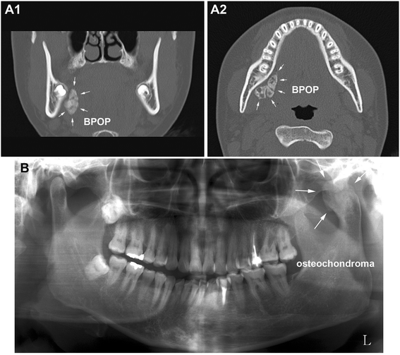 Bizarre parosteal osteochondromatous proliferation in the lingual area ...