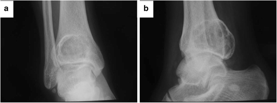 Reconstruction with double pedicel fibular graft and ankle arthrodesis ...