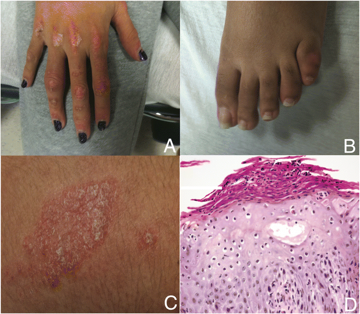 Enthesitis as a component of dactylitis in psoriatic juvenile ...