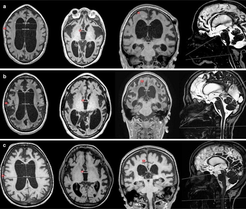 Correlation of CSF flow using phase-contrast MRI with ventriculomegaly ...