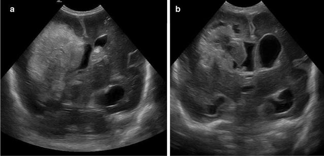Opportunities in posthemorrhagic hydrocephalus research: outcomes of ...