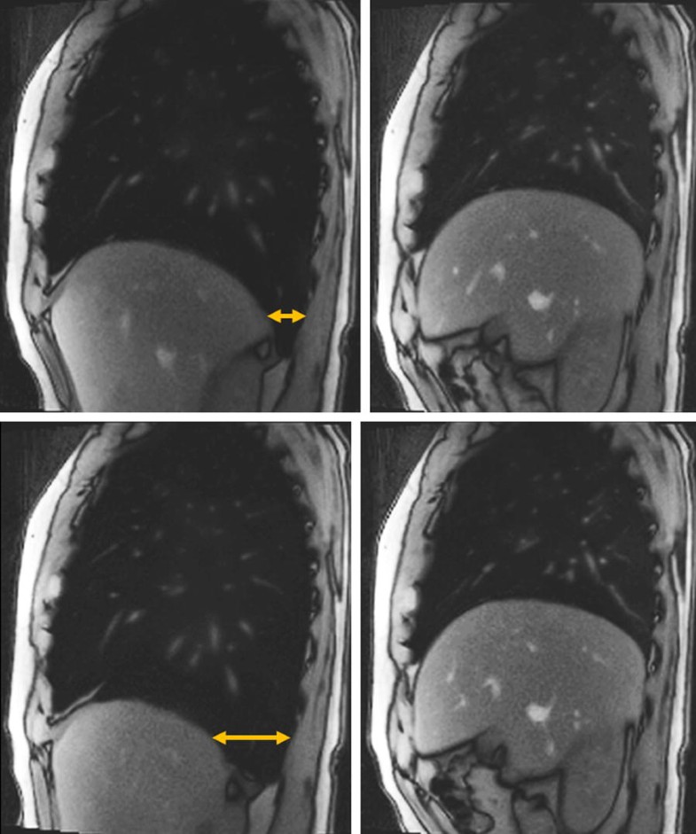 Spinal CSF flow in response to forced thoracic and abdominal ...