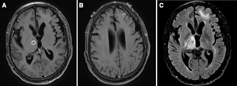An unusual and challenging case of HIV-associated primary CNS Lymphoma ...