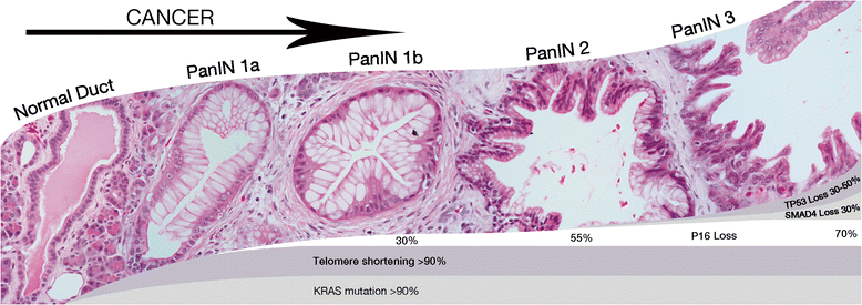 Surgical and molecular pathology of pancreatic neoplasms | Diagnostic Pathology | Full Text