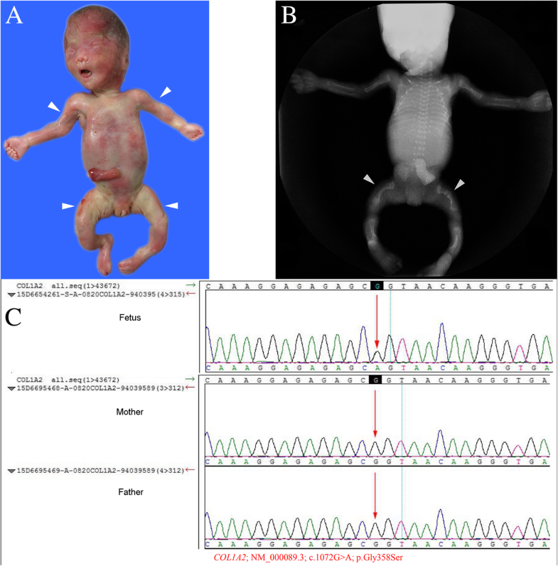 Prenatal diagnosis of fetal skeletal dysplasia using targeted next ...