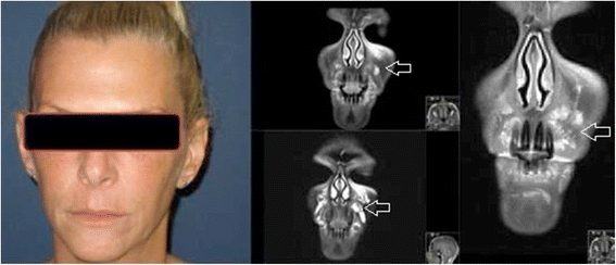 MRI in detecting facial cosmetic injectable fillers | Head & Face ...