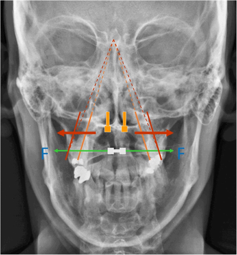 Surgically assisted rapid maxillary expansion in lingual orthodontics – optimizing of coupling ...