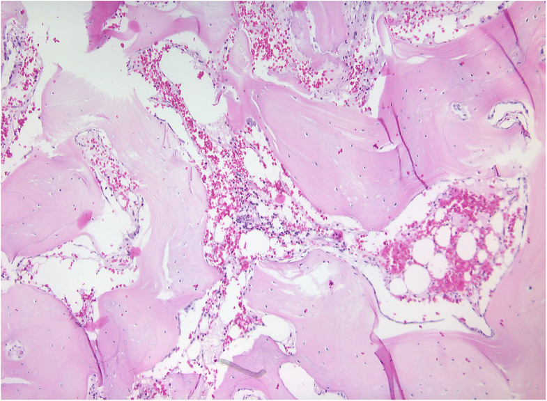 Myositis ossificans traumatica of the masticatory muscles: etiology ...