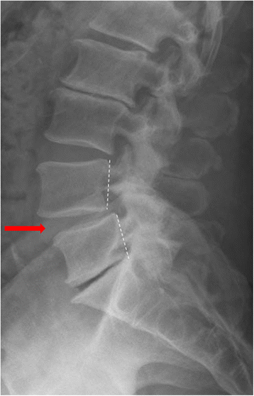 Is lumbar facet joint tropism developmental or secondary to ...