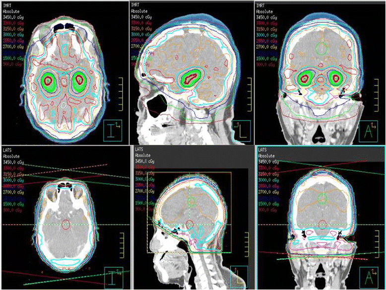 Dosimetric analysis of the alopecia preventing effect of hippocampus ...