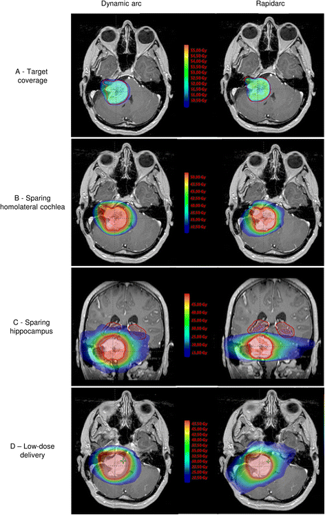 Fractionated stereotactic radiotherapy of benign skull-base tumors: a ...