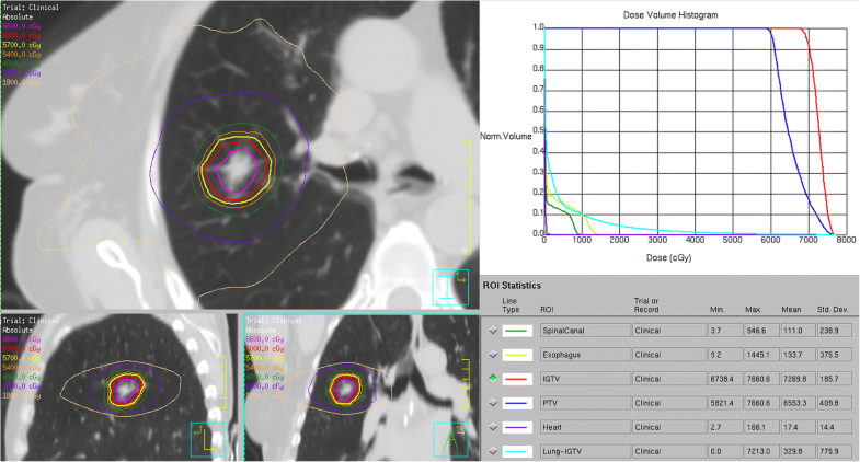 Stereotactic ablative radiotherapy for early-stage lung cancer following double lung ...