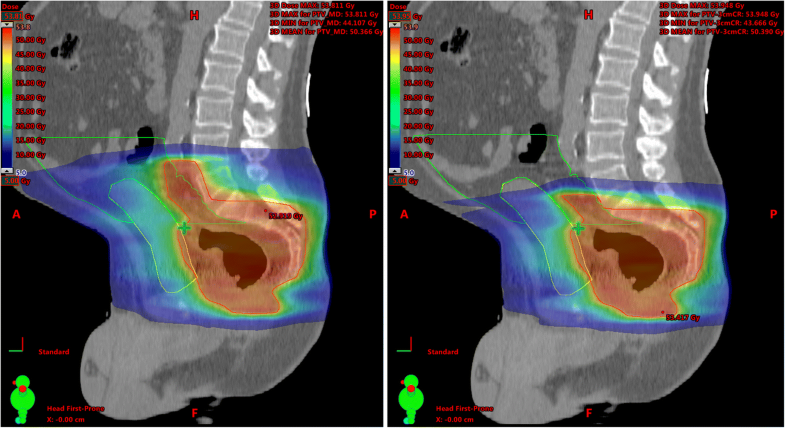 Dosimetric analysis and comparison of reduced longitudinal cranial ...