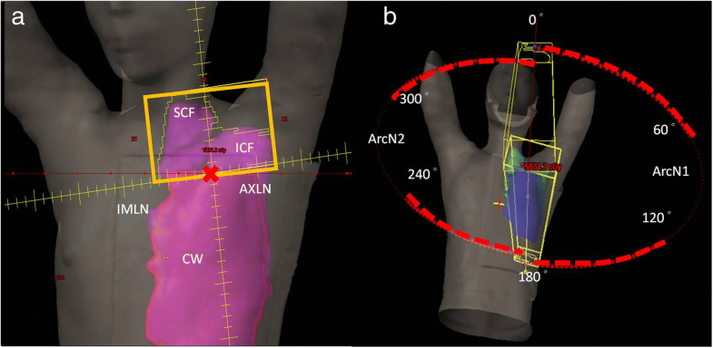 Tangent-based volumetric modulated arc therapy for advanced left breast ...