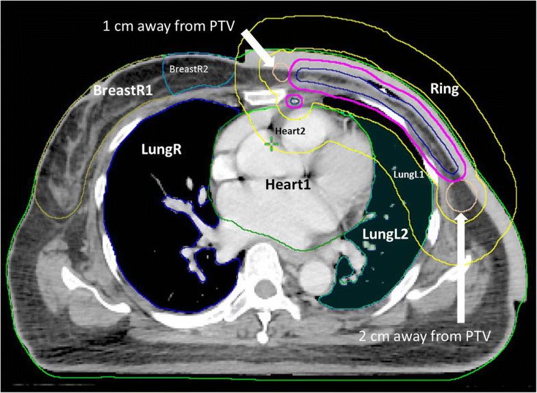 Tangent-based volumetric modulated arc therapy for advanced left breast ...