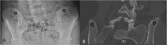 Evaluation of accuracy of plain radiography in determining the Risser ...