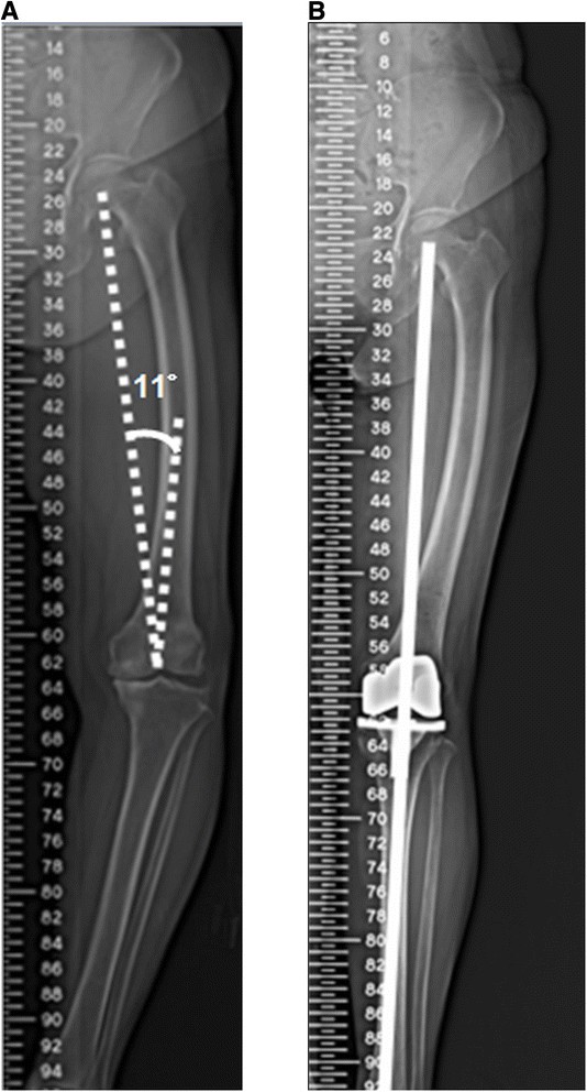 The benefits of computer-assisted total knee arthroplasty on coronal alignment with marked ...