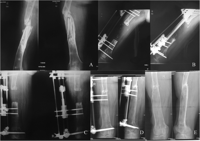 Infected nonunion of tibia and femur treated by bone transport ...