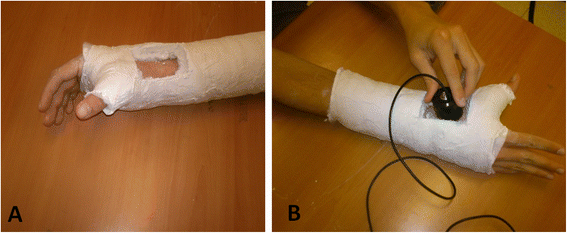 Low-intensity pulsed ultrasound for treating delayed union scaphoid ...