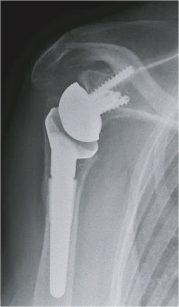 Prosthesis design and placement in reverse total shoulder arthroplasty ...