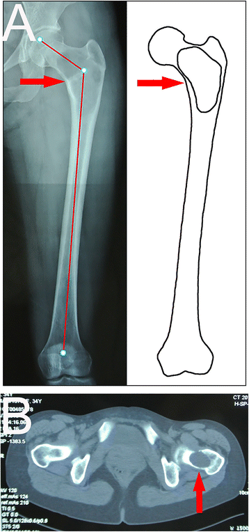 Radiographic classification and treatment of fibrous dysplasia of the ...