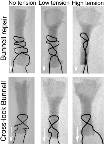 Bunnell or cross-lock Bunnell suture for tendon repair? Defining the ...