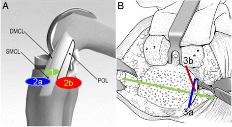 Selective medial soft tissue release combined with tibial reduction osteotomy in total knee ...
